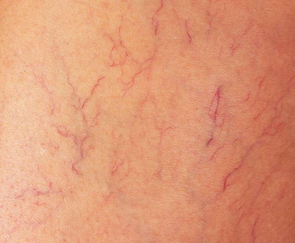 Vascular Lesions - Venetian Medical Spa and Aesthetic Surgery