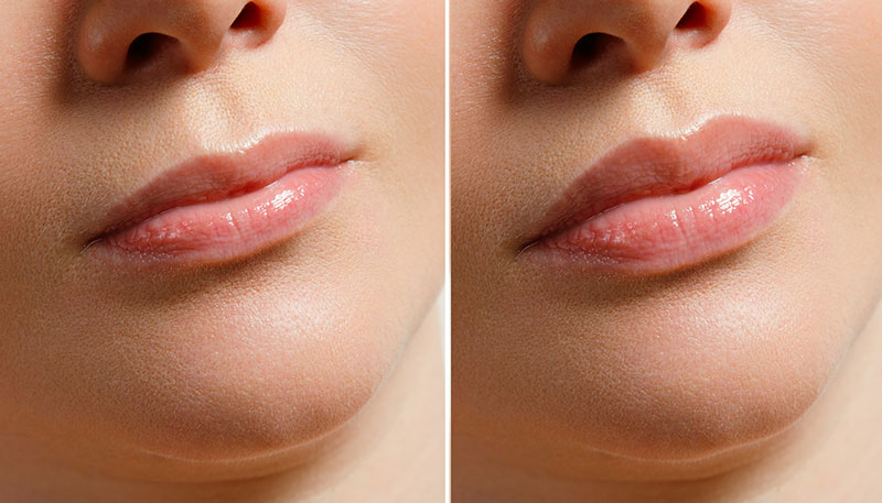 Lip Fillers: Your Ultimate Guide