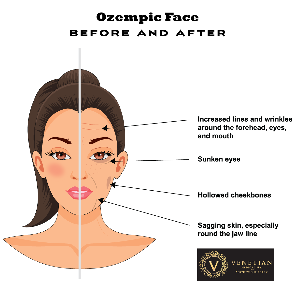 Ozempic Face Treatments: Reversing the Effects of Volume Loss
