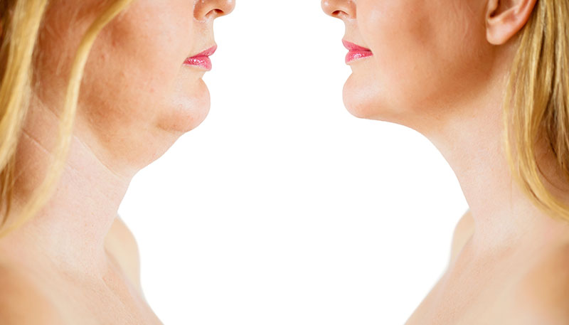MyEllevate: A Minimally Invasive Facelift Alternative