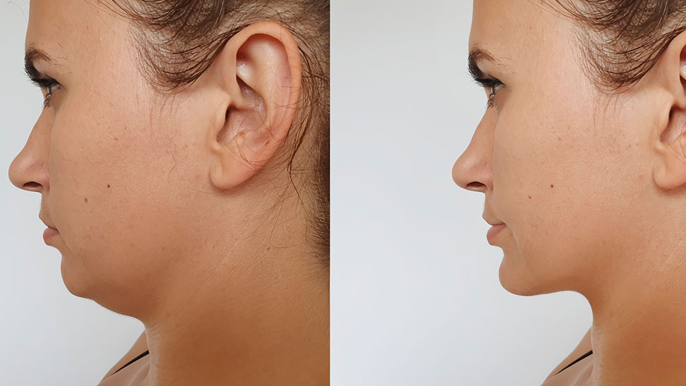 MyEllevate: A Minimally Invasive Facelift Alternative